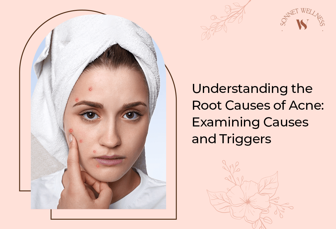 Understanding the Root Causes of Acne: Examining Causes and Triggers – Sonnet Wellness