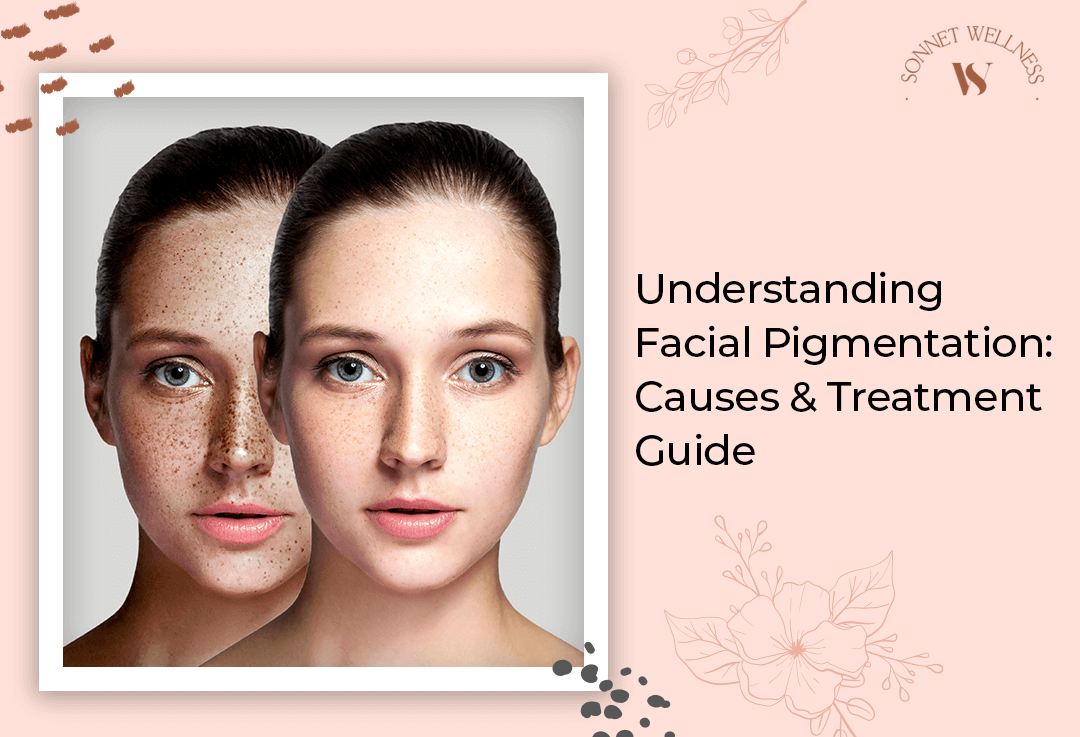 Understanding Facial Pigmentation : Causes & Treatment Guide – Sonnet Wellness